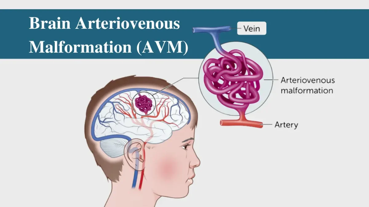 Brain Avm Arteriovenous Malformation Symptoms And Human And Mouse