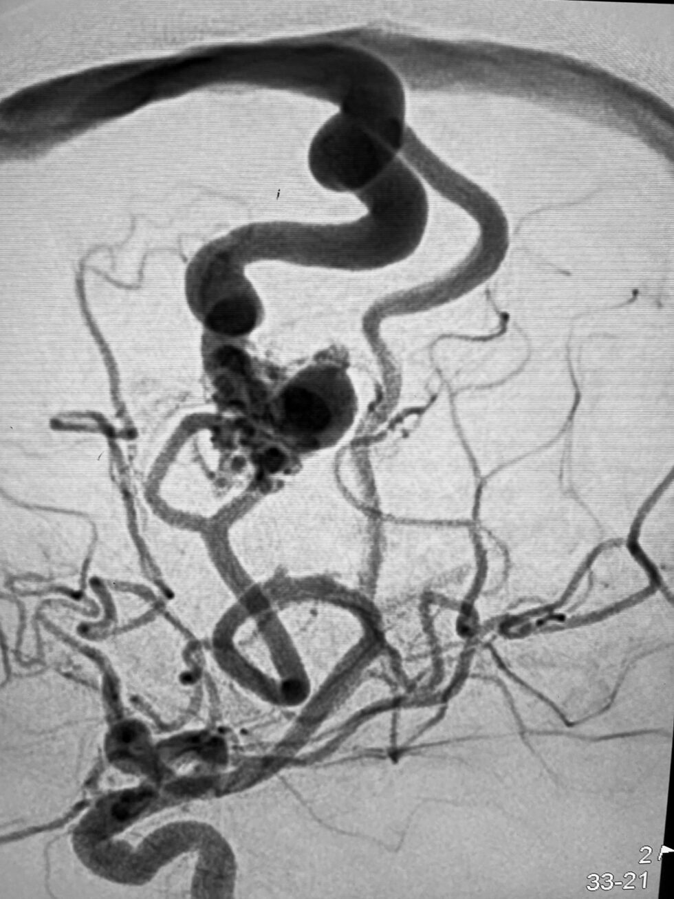 Brain Arteriovenous Malformation Cause, Symptoms & Treatment